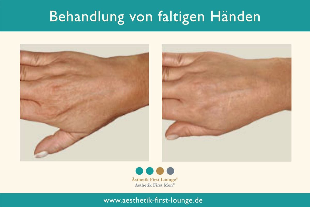 Faltige Hände verjüngen mit Hyaluron - Ästhetik First Lounge